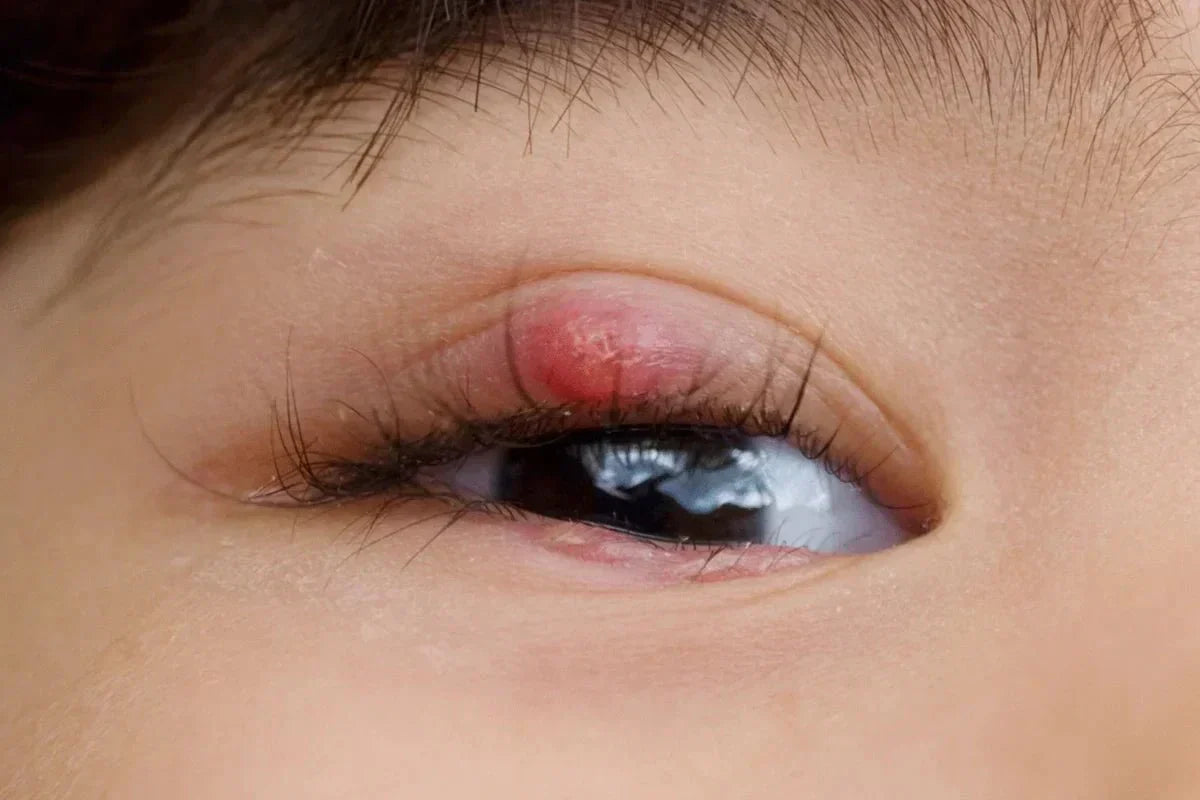 What is a Stye in your eye and how do you treat it? – Dry Eye Mask